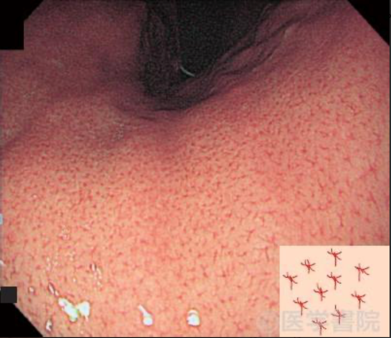 胃カメラ（胃内視鏡検査）検査で分かる疾患〜H.pylori未感染時の所見について〜 | 浅草きずなクリニック